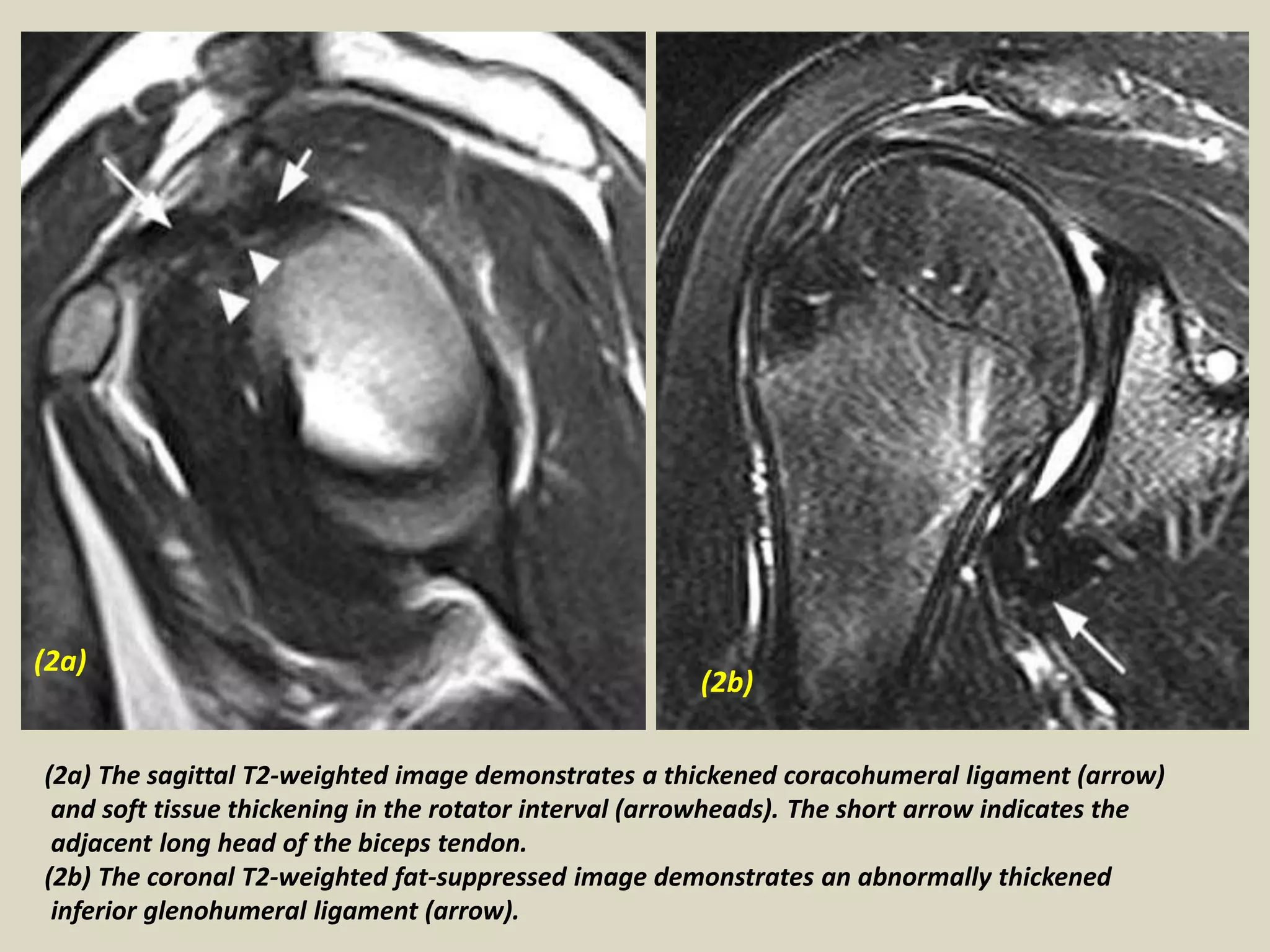 Presentation1, radiological imaging of adhesive capsulitis(frozen ...