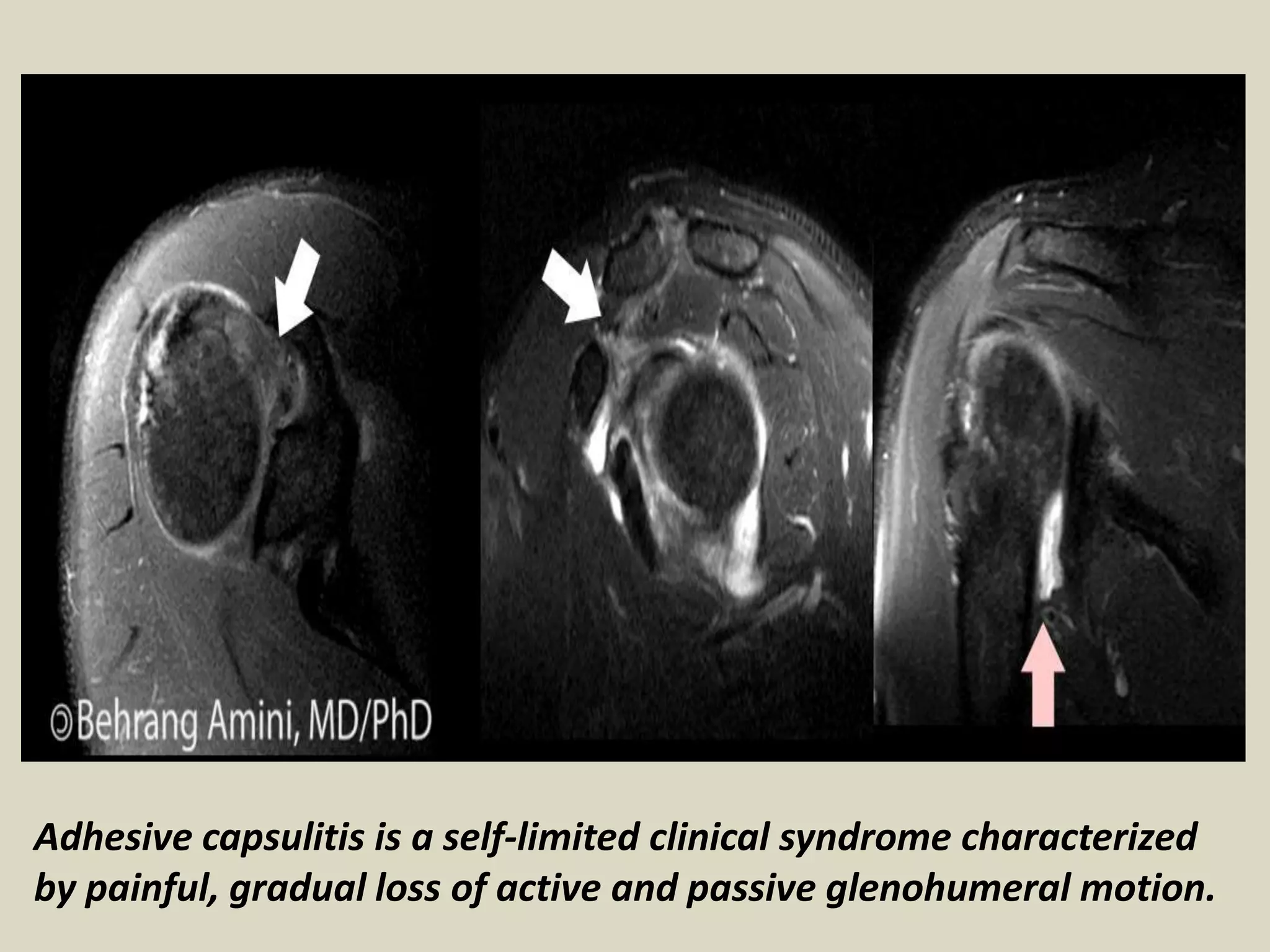 Presentation1, radiological imaging of adhesive capsulitis(frozen ...