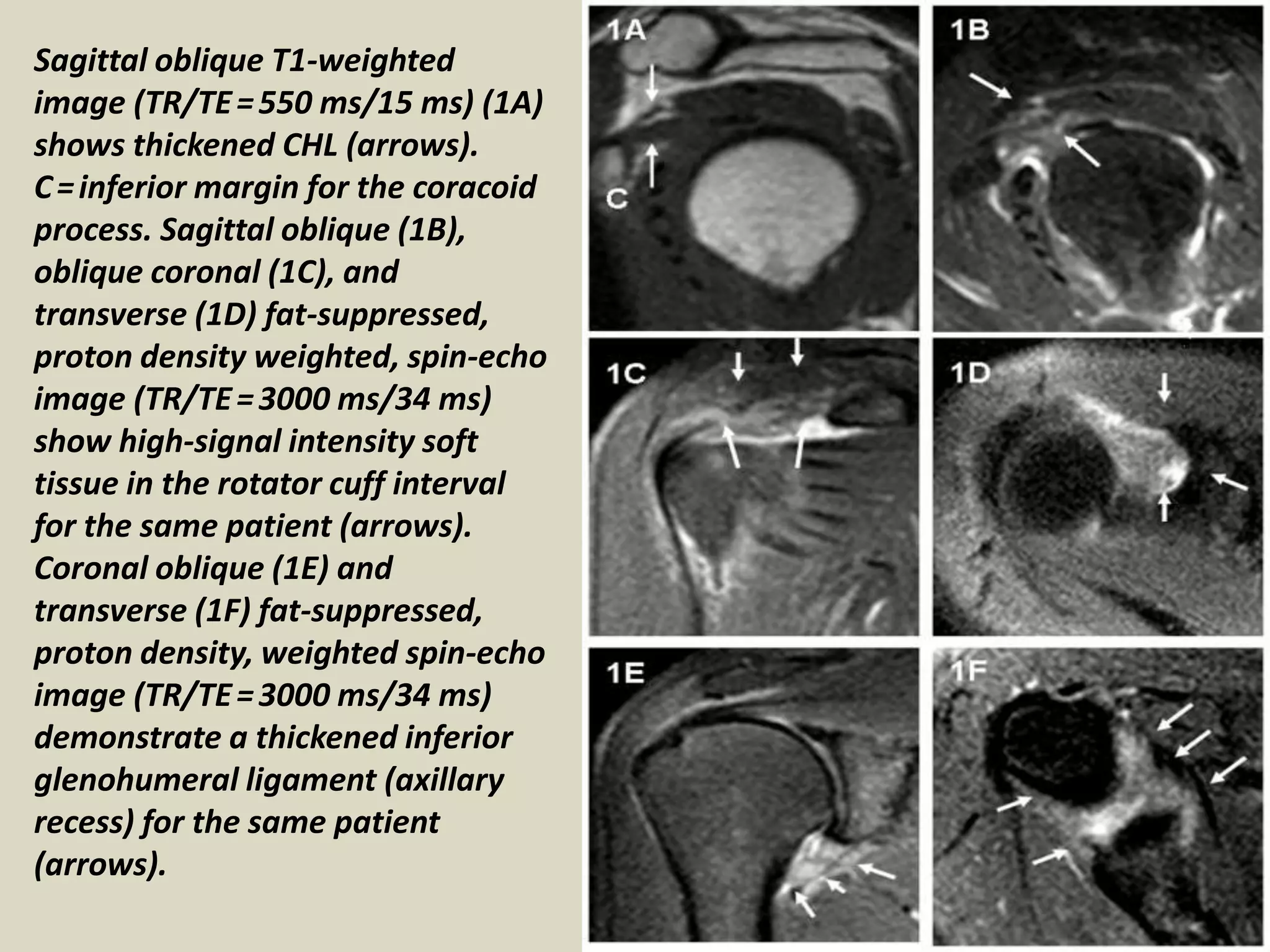 Presentation1, radiological imaging of adhesive capsulitis(frozen ...