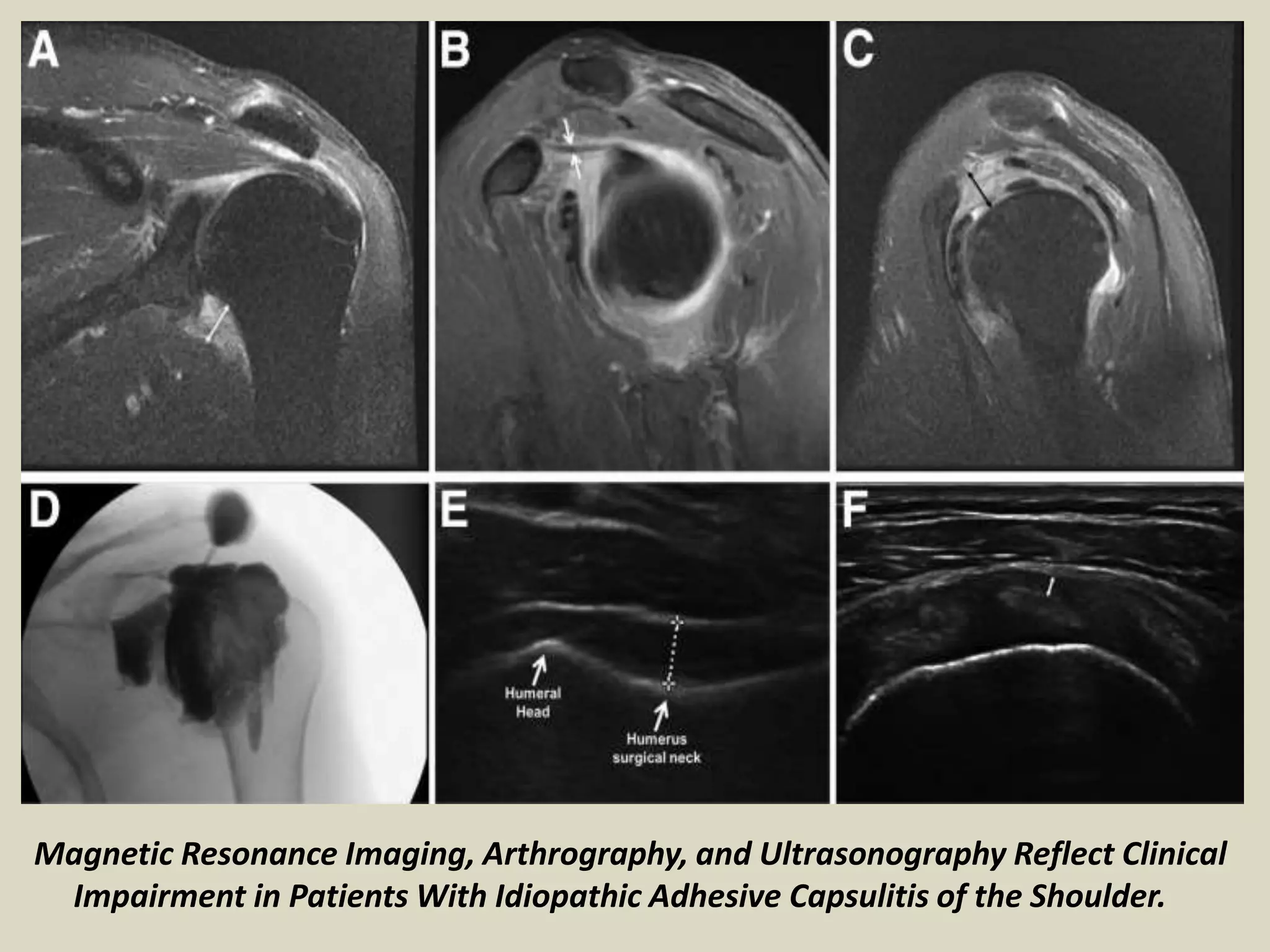 Presentation1, radiological imaging of adhesive capsulitis(frozen ...