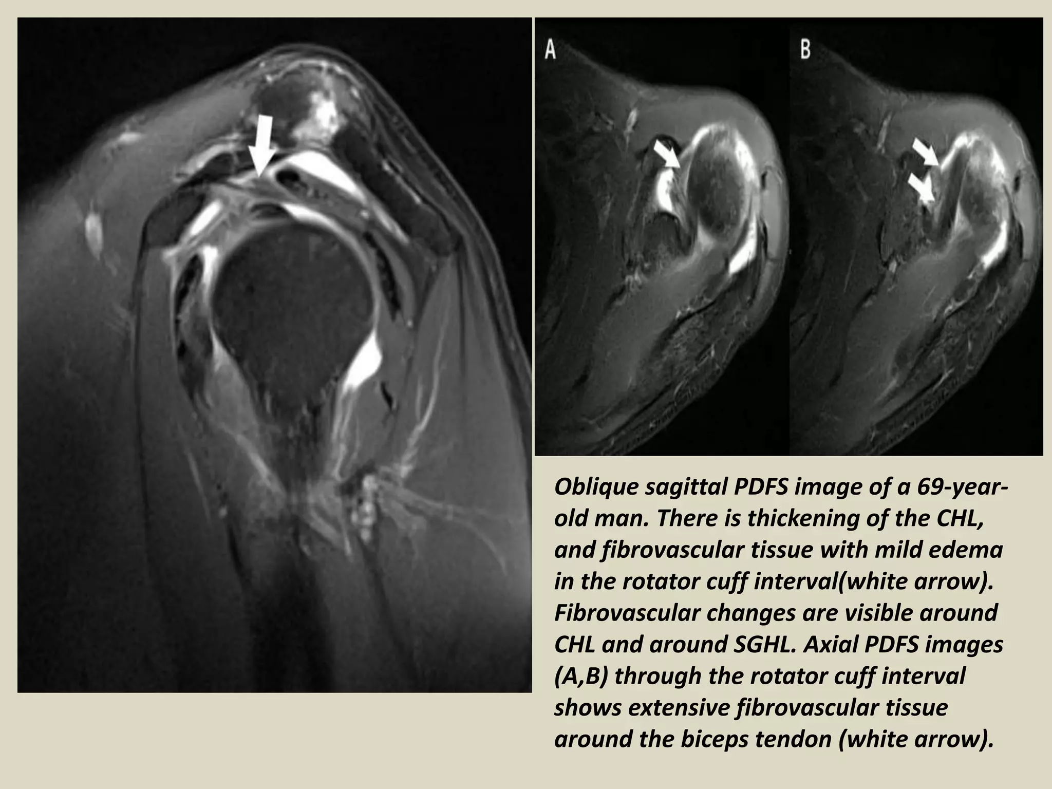 Presentation1, radiological imaging of adhesive capsulitis(frozen ...