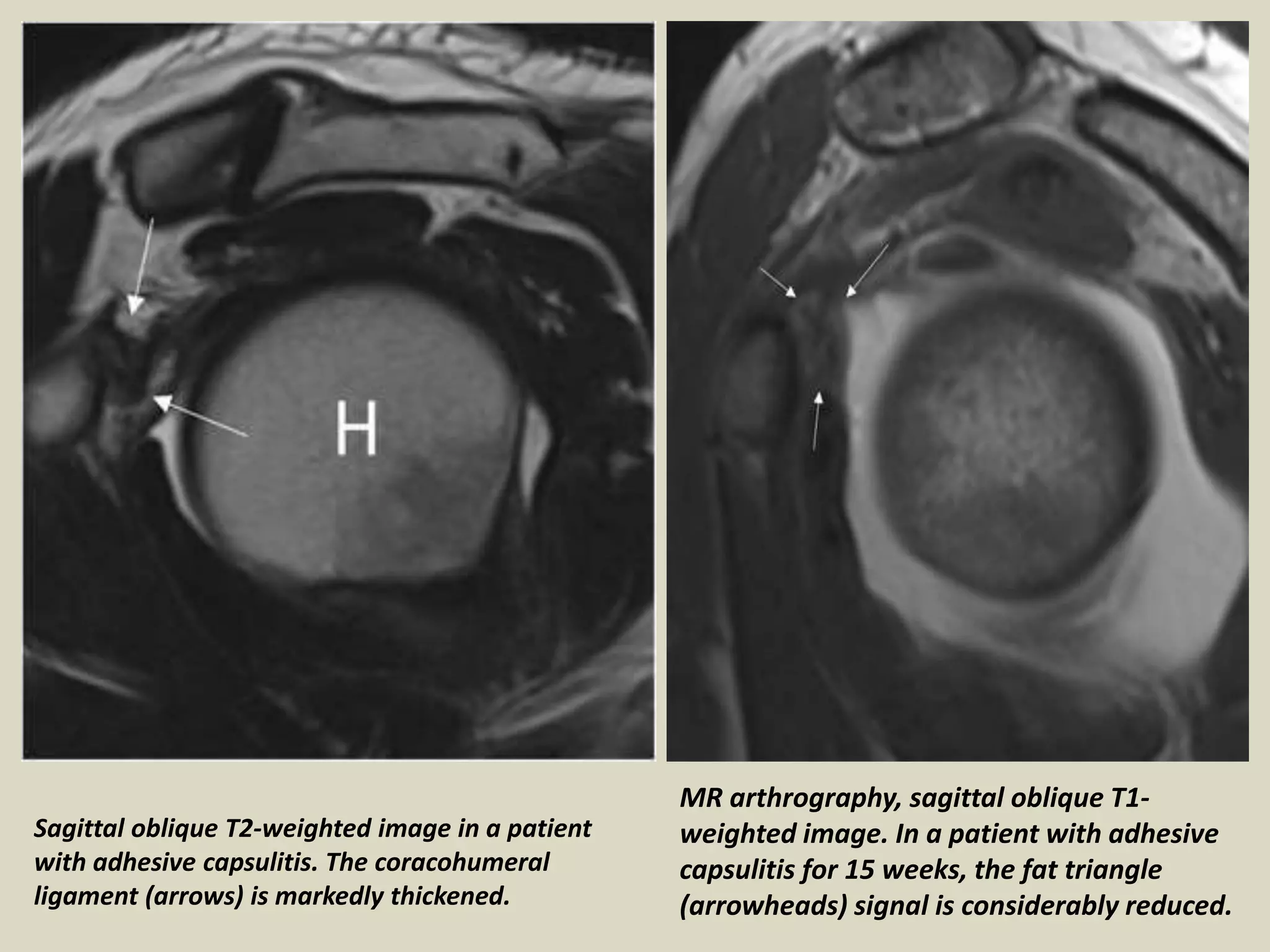 Presentation1, radiological imaging of adhesive capsulitis(frozen ...
