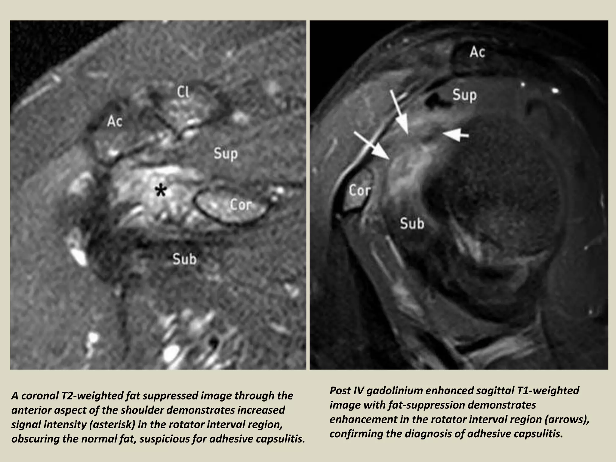 Presentation1, radiological imaging of adhesive capsulitis(frozen ...