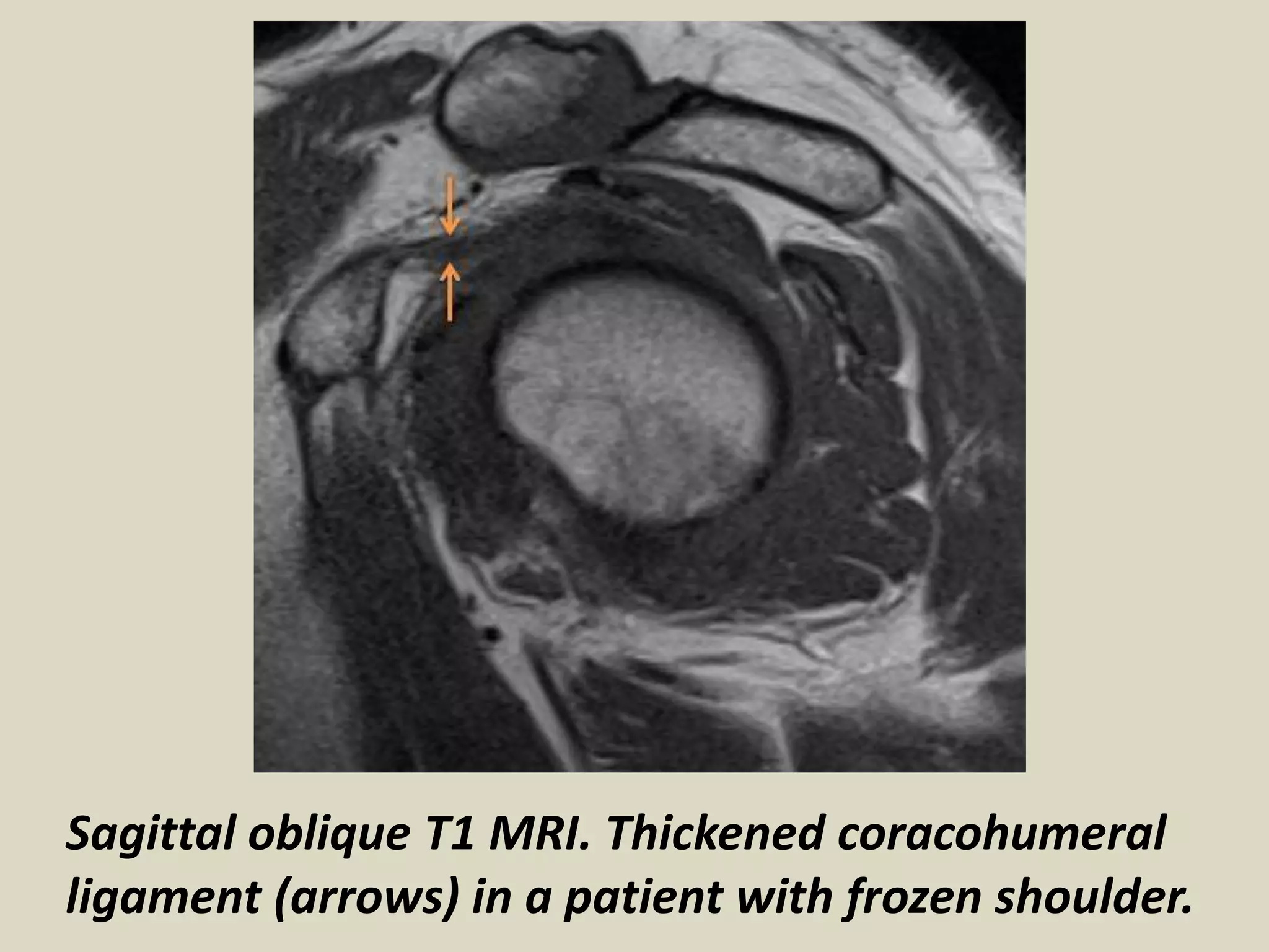 Presentation1, radiological imaging of adhesive capsulitis(frozen ...
