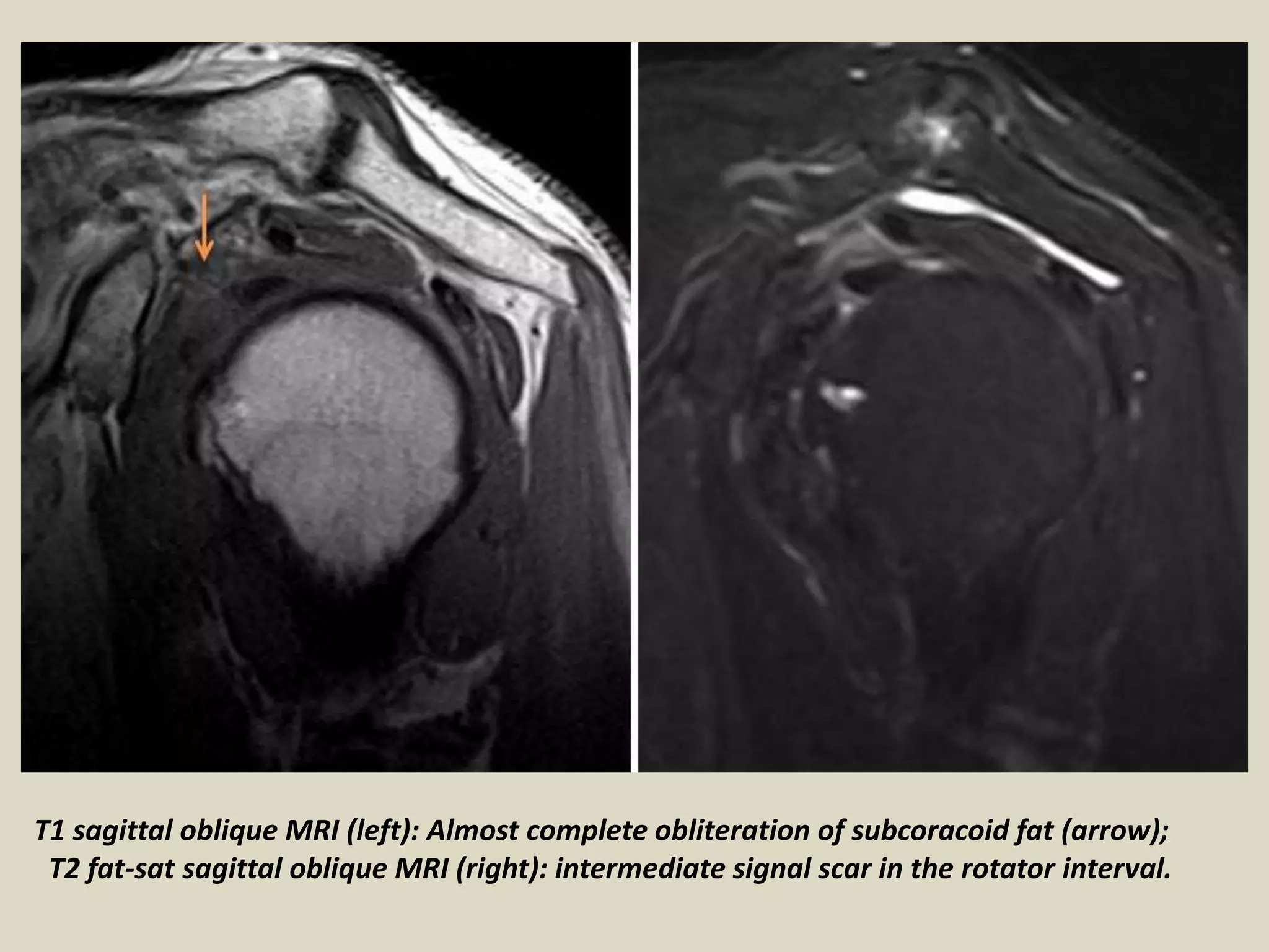 Presentation1, radiological imaging of adhesive capsulitis(frozen ...