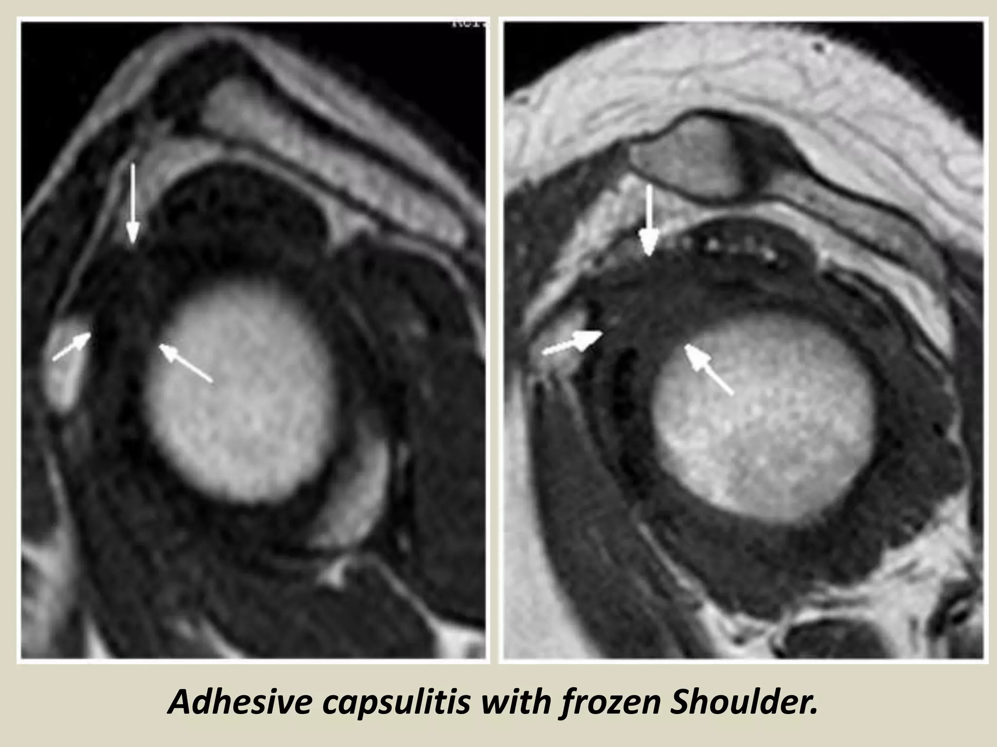 Presentation1, radiological imaging of adhesive capsulitis(frozen ...