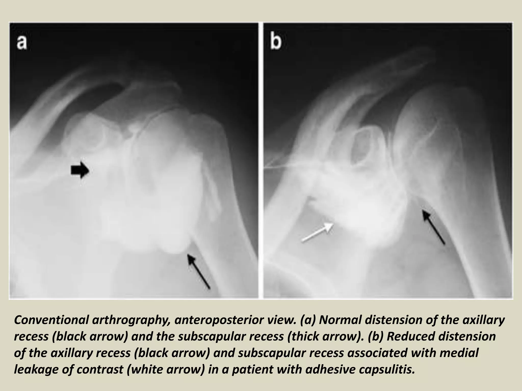 Presentation1, radiological imaging of adhesive capsulitis(frozen ...