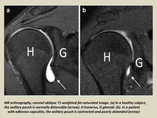 Presentation1, radiological imaging of adhesive capsulitis(frozen ...