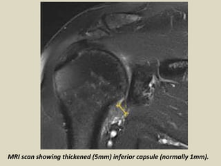 Presentation1, radiological imaging of adhesive capsulitis(frozen ...
