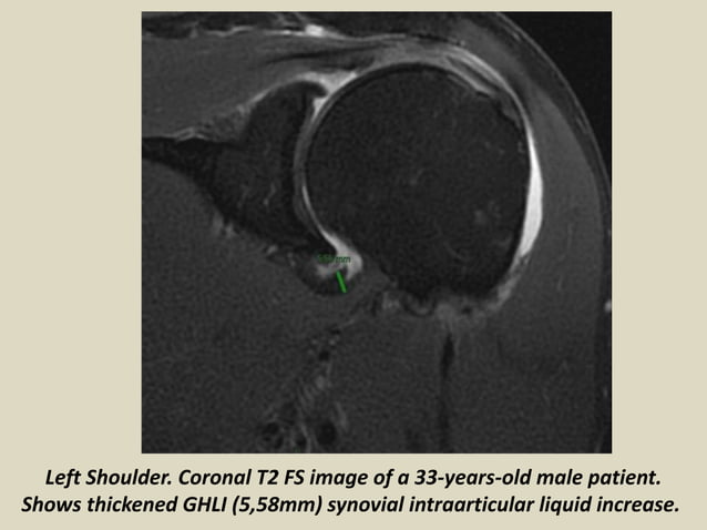 Presentation1, radiological imaging of adhesive capsulitis(frozen ...