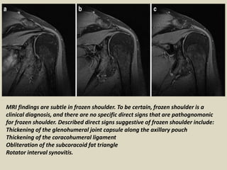 Presentation1, radiological imaging of adhesive capsulitis(frozen ...
