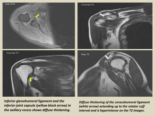 Presentation1, radiological imaging of adhesive capsulitis(frozen ...