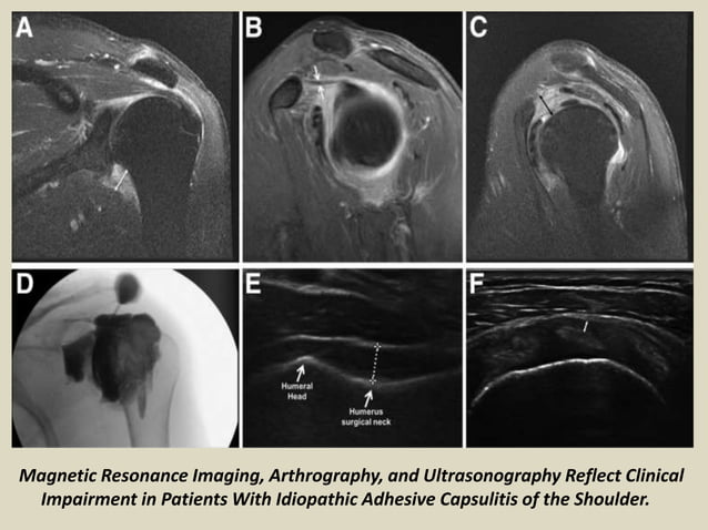 Presentation1, radiological imaging of adhesive capsulitis(frozen ...