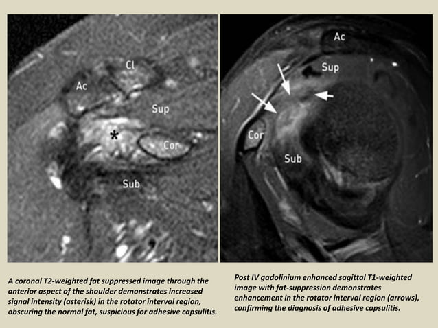 Presentation1, radiological imaging of adhesive capsulitis(frozen ...