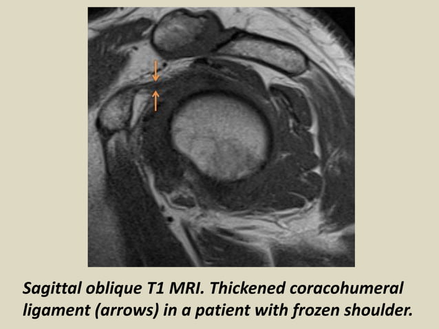 Presentation1, radiological imaging of adhesive capsulitis(frozen ...