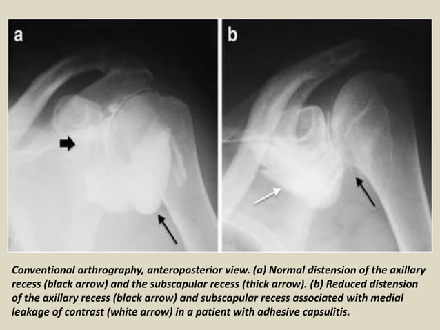Presentation1, radiological imaging of adhesive capsulitis(frozen ...