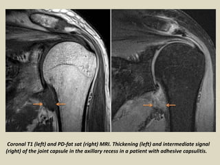 Presentation1, radiological imaging of adhesive capsulitis(frozen ...