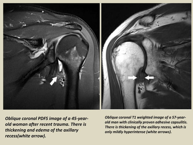 Presentation1, radiological imaging of adhesive capsulitis(frozen ...