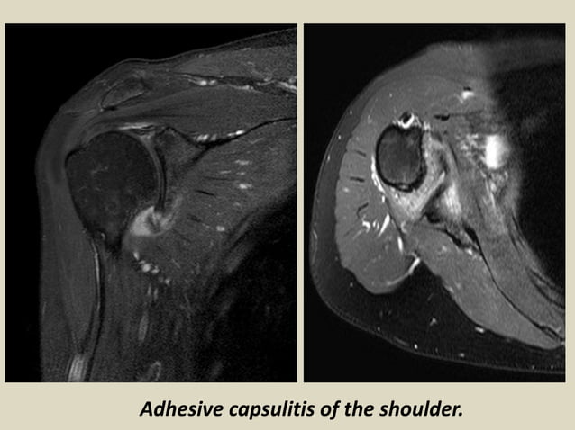 Presentation1, radiological imaging of adhesive capsulitis(frozen ...