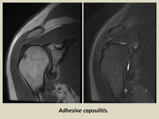 Presentation1, radiological imaging of adhesive capsulitis(frozen ...