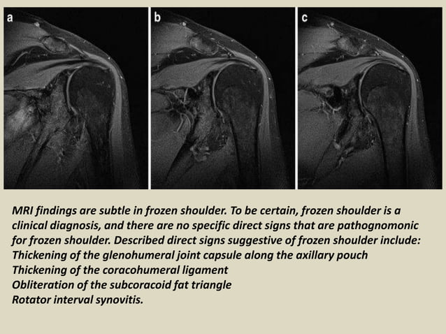 Presentation1, radiological imaging of adhesive capsulitis(frozen ...