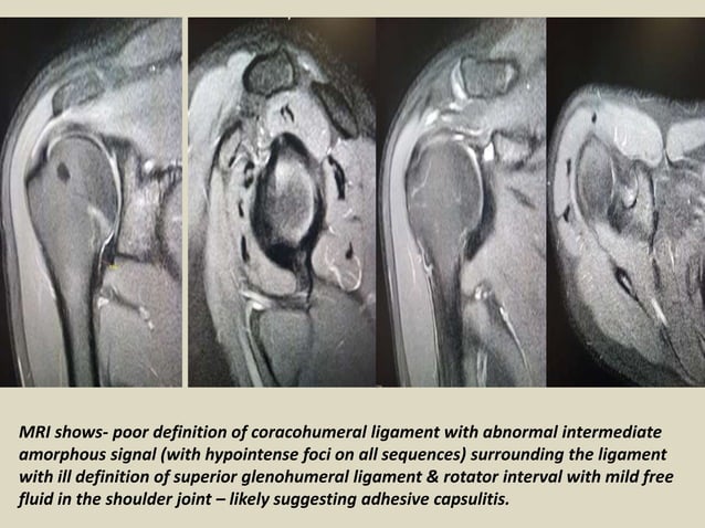 Presentation1, radiological imaging of adhesive capsulitis(frozen ...