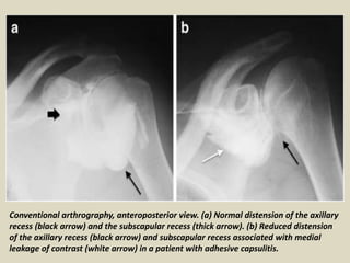 Presentation1, radiological imaging of adhesive capsulitis(frozen ...