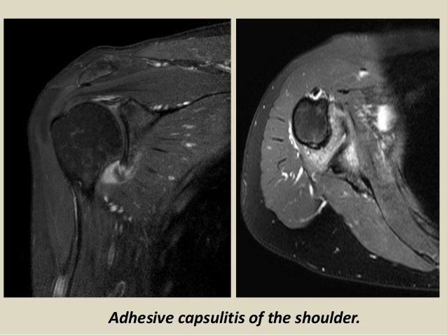 Presentation1, radiological imaging of adhesive capsulitis(frozen sho…