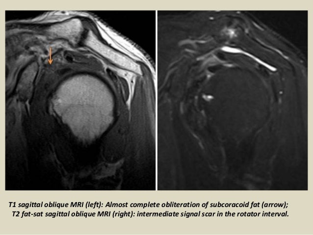 Presentation1, radiological imaging of adhesive capsulitis(frozen sho…