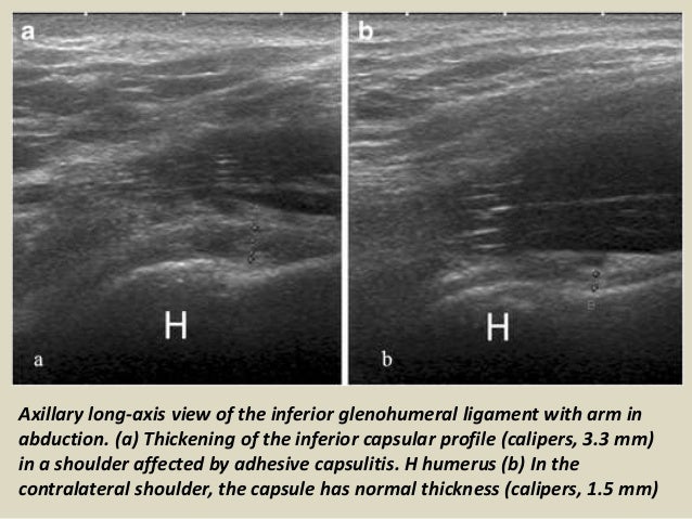 Presentation1, radiological imaging of adhesive capsulitis(frozen sho…