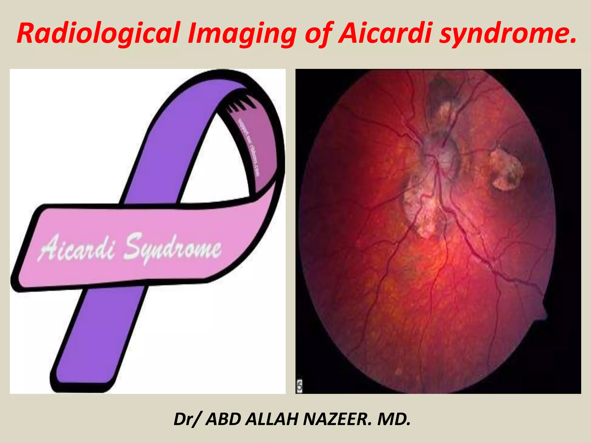 Presentation1, radiological imaging of aicardi syndrome. | PPTX