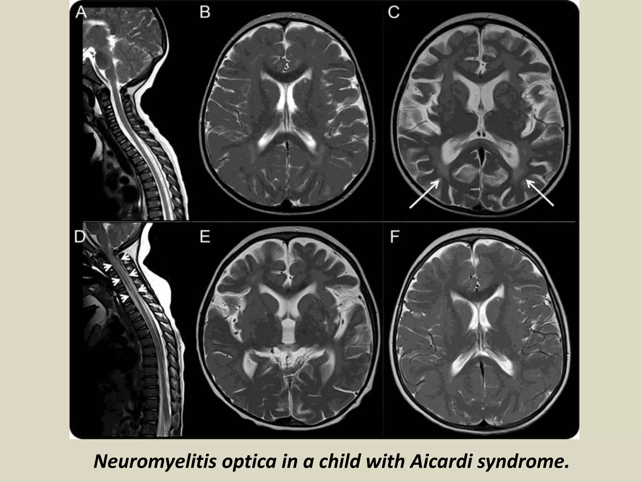 Presentation1, radiological imaging of aicardi syndrome. | PPTX