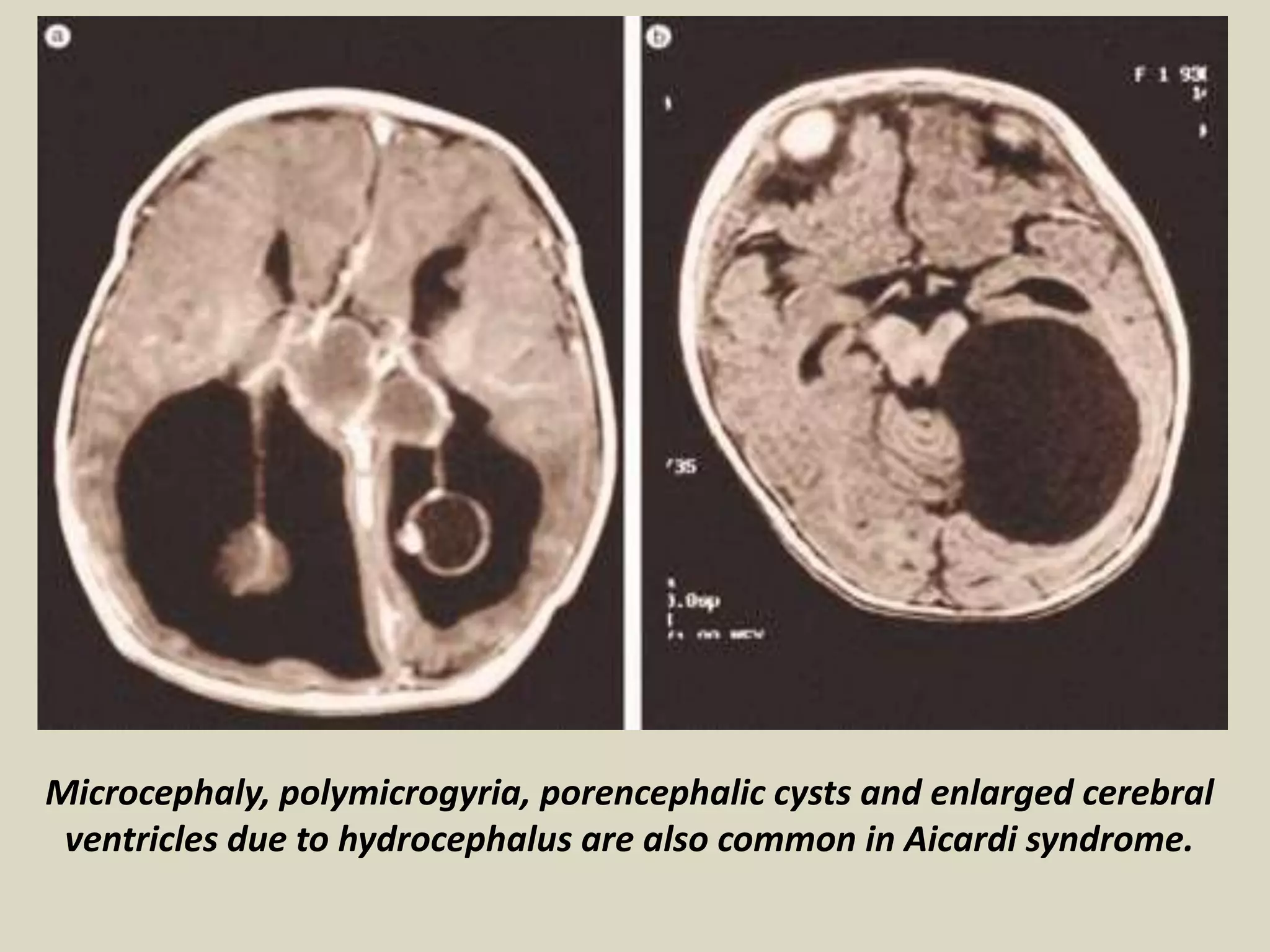 Presentation1, radiological imaging of aicardi syndrome. | PPTX