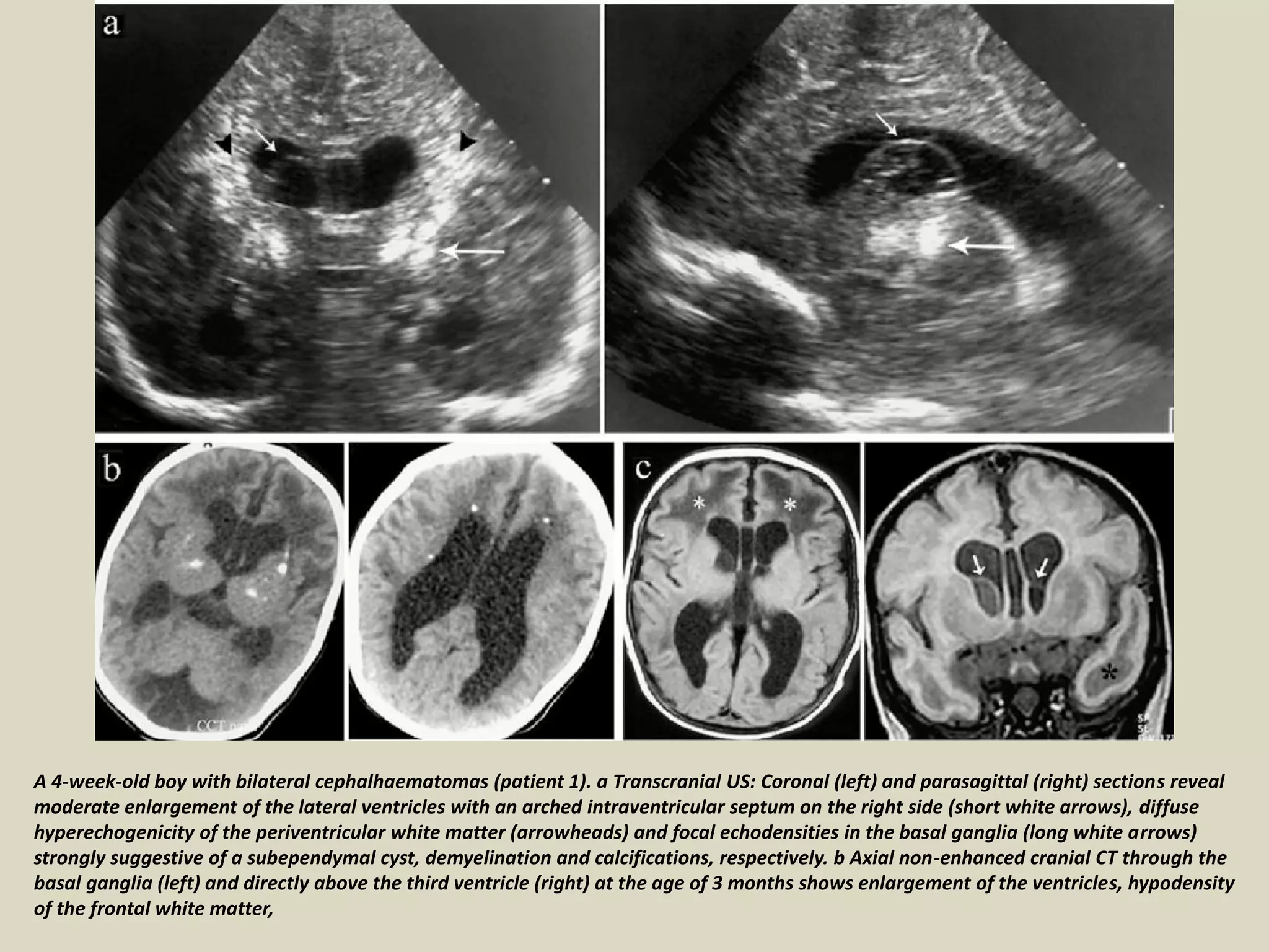Presentation1, radiological imaging of aicardi syndrome. | PPTX