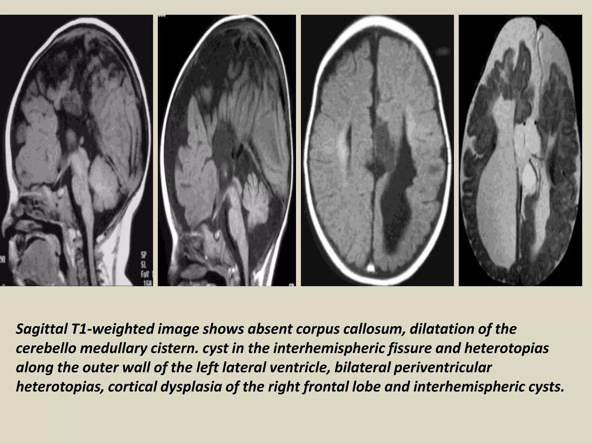 Presentation1, radiological imaging of aicardi syndrome. | PPTX
