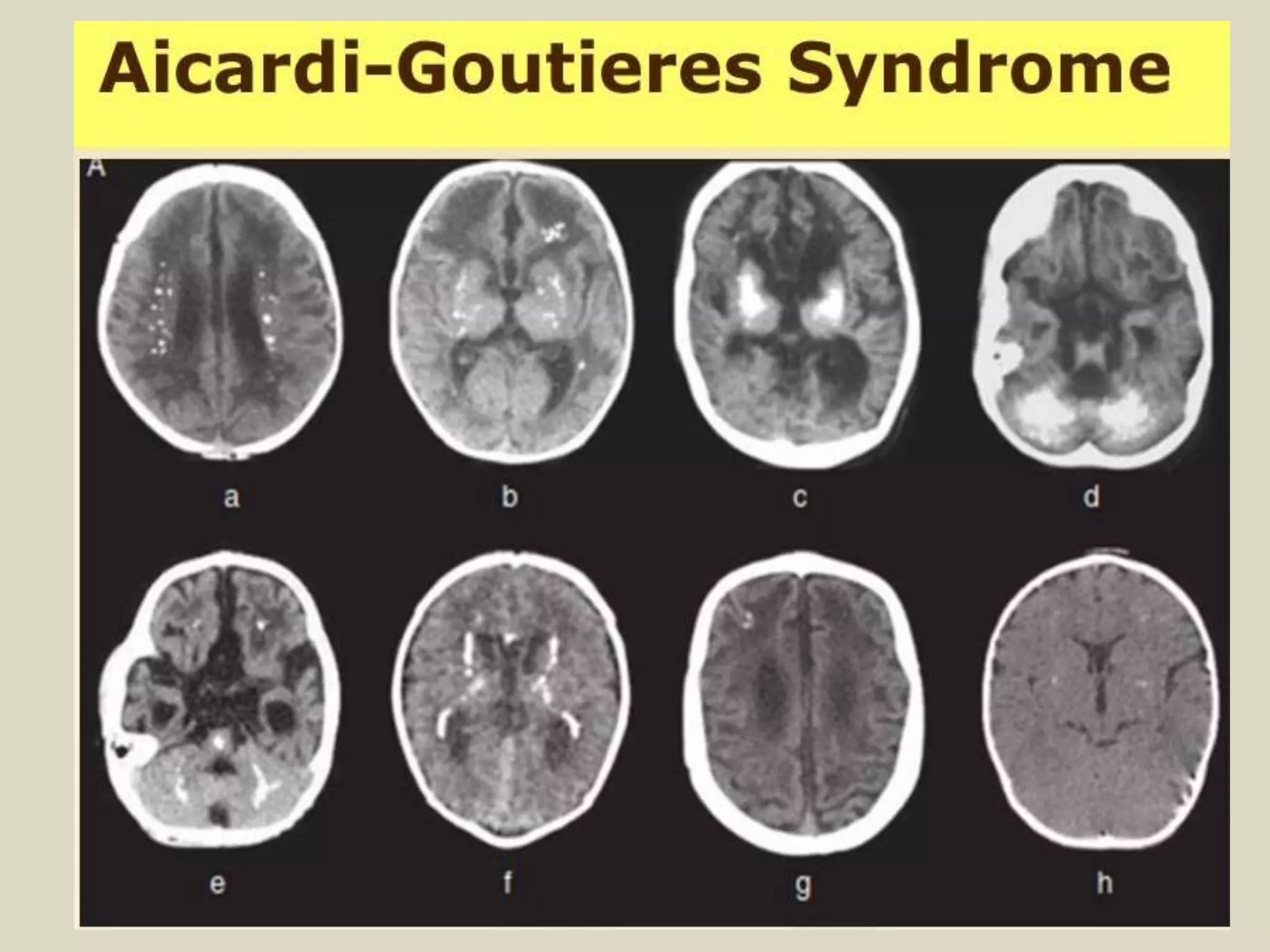 Presentation1, radiological imaging of aicardi syndrome. | PPTX