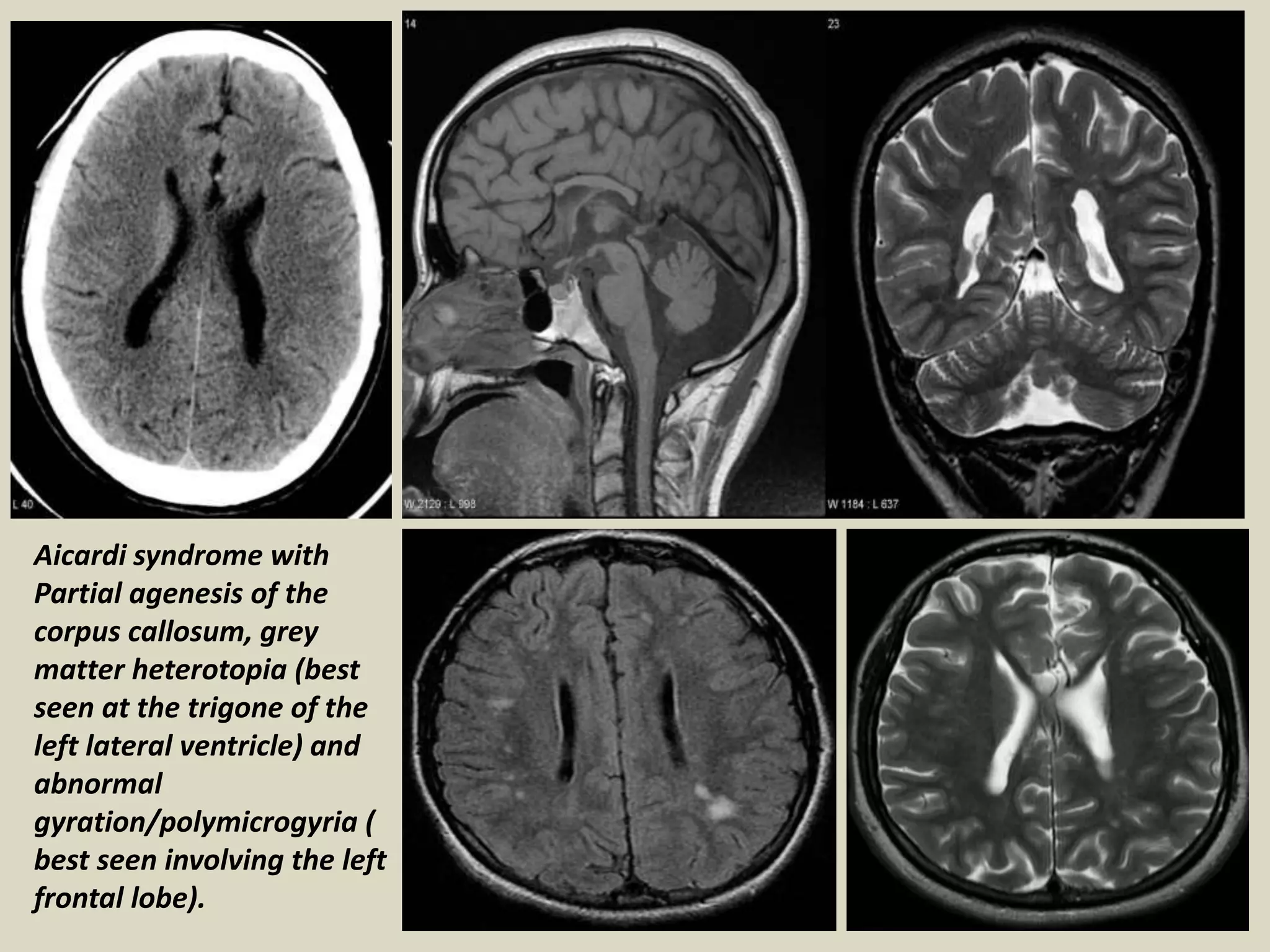 Presentation1, radiological imaging of aicardi syndrome. | PPTX