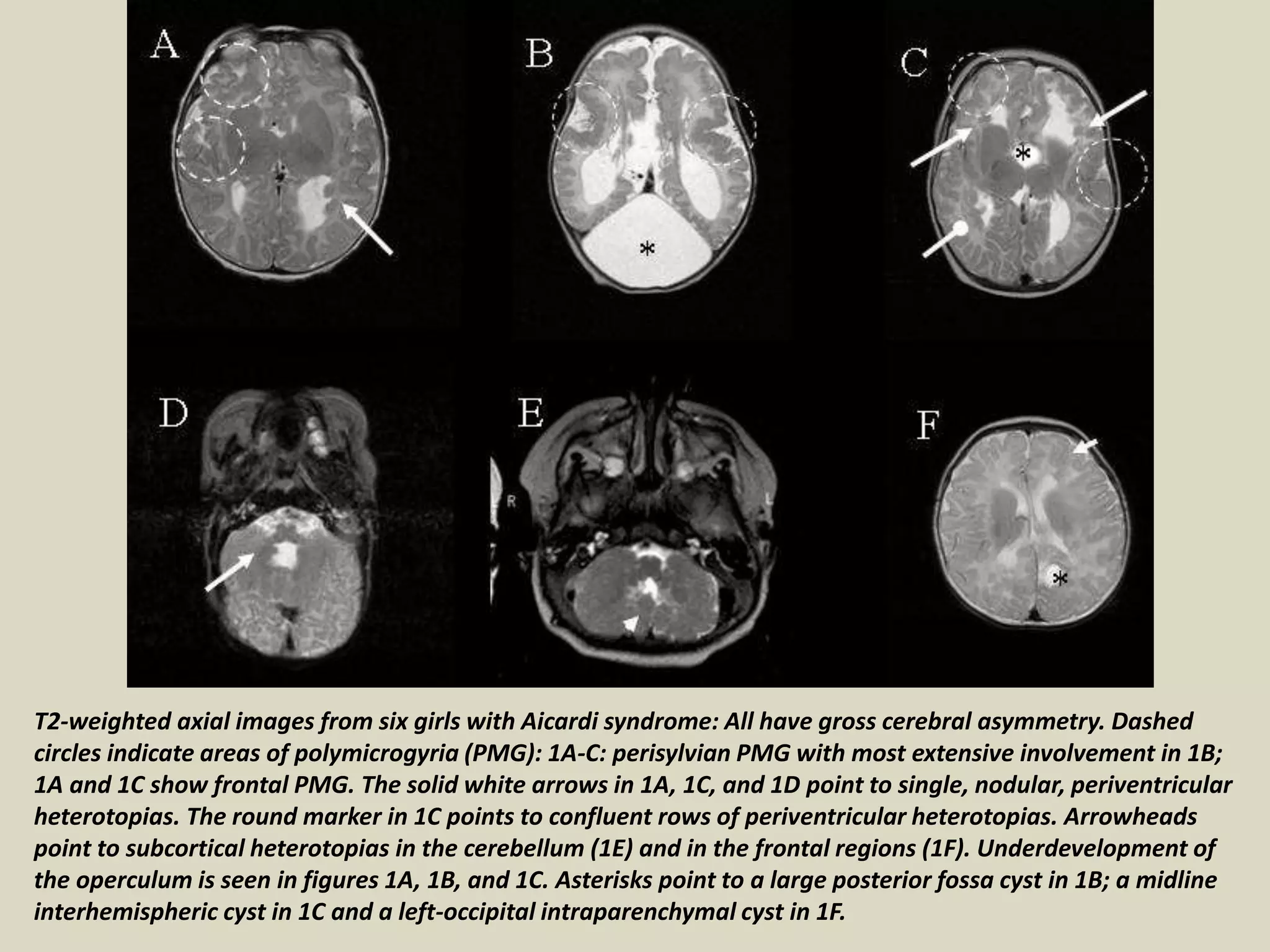 Presentation1, radiological imaging of aicardi syndrome. | PPTX