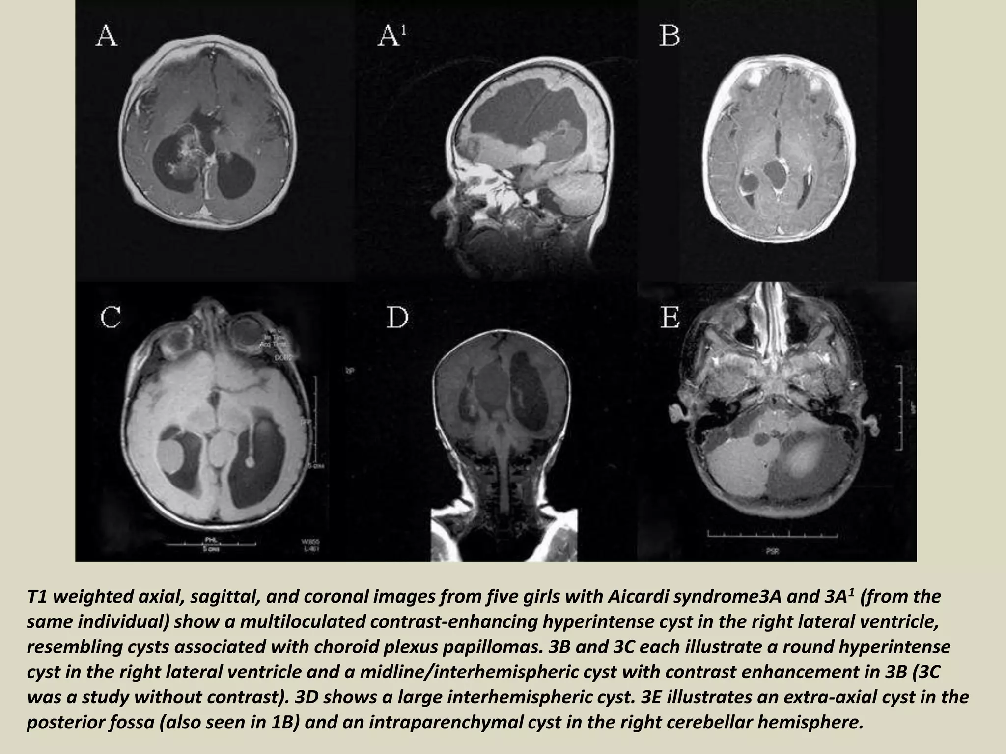 Presentation1, radiological imaging of aicardi syndrome. | PPTX