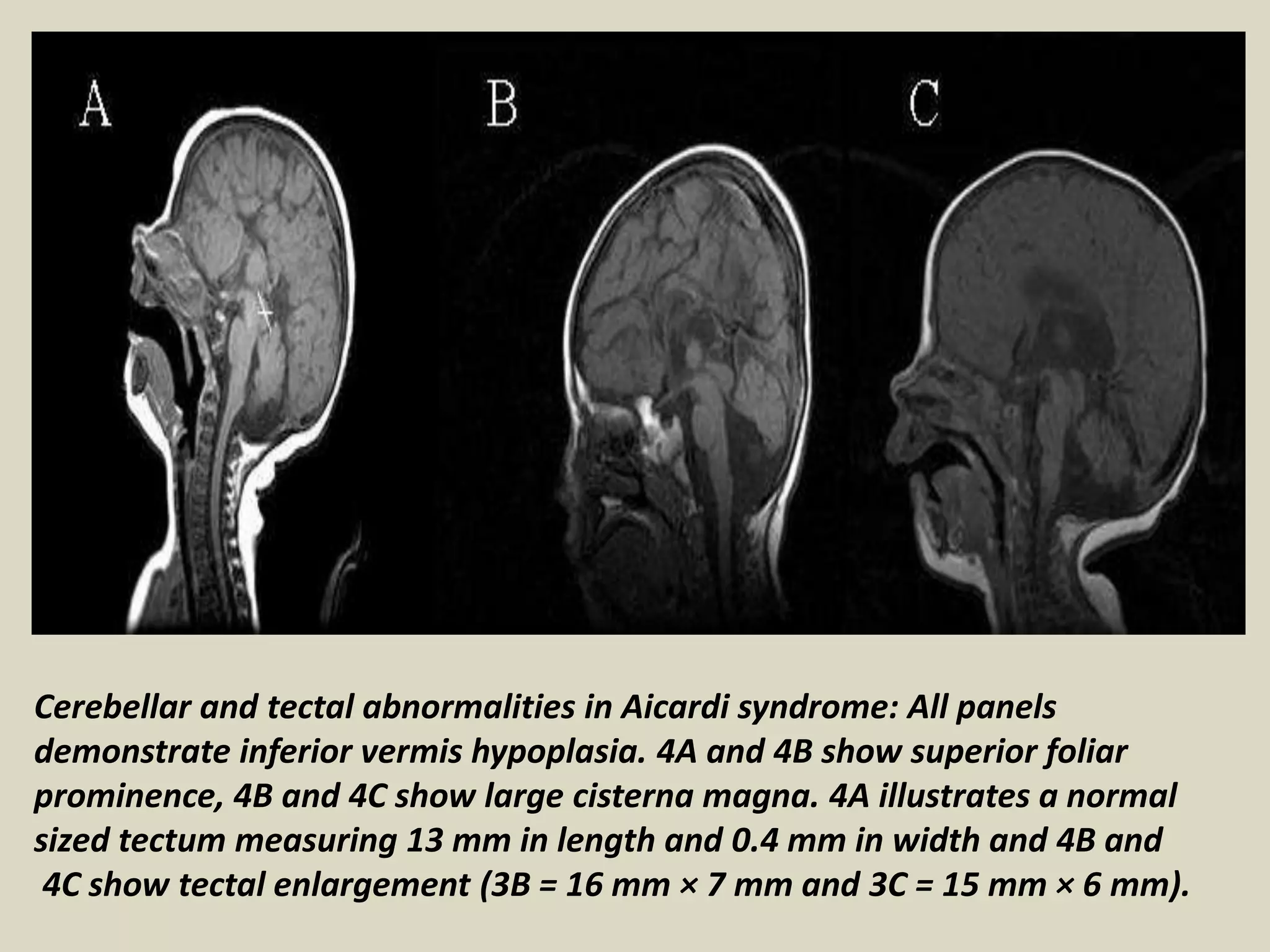 Presentation1, radiological imaging of aicardi syndrome. | PPTX