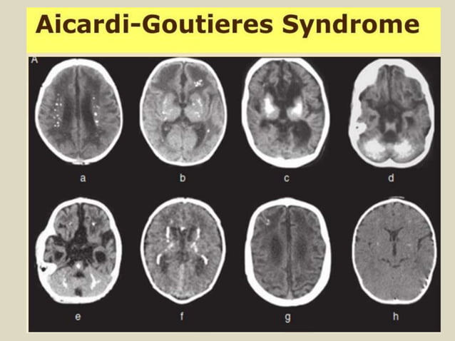 Presentation1, radiological imaging of aicardi syndrome. | PPTX | Brain ...