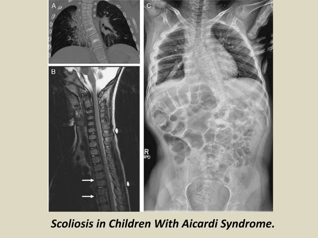 Presentation1, radiological imaging of aicardi syndrome. | PPTX | Brain ...