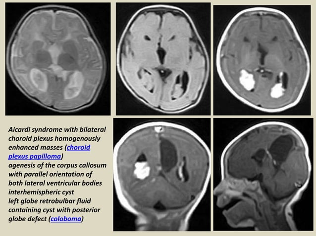 Presentation1, radiological imaging of aicardi syndrome. | PPTX | Brain ...