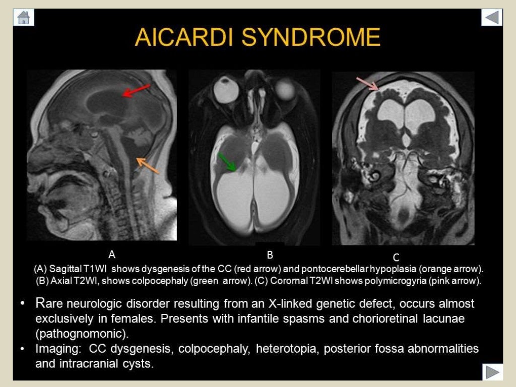 Presentation1, radiological imaging of aicardi syndrome.