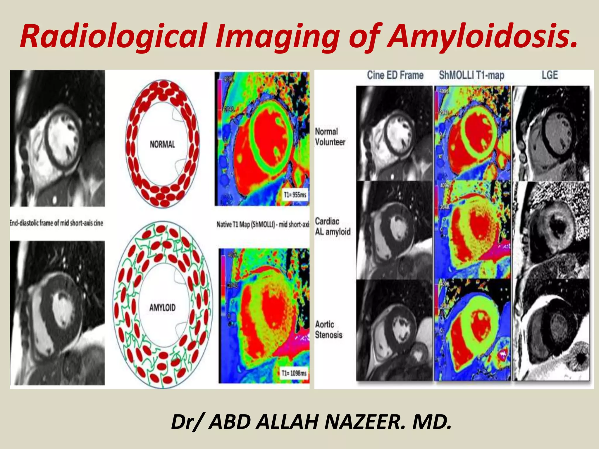Presentation1, radiological imaging of amyloidosis. | PPTX