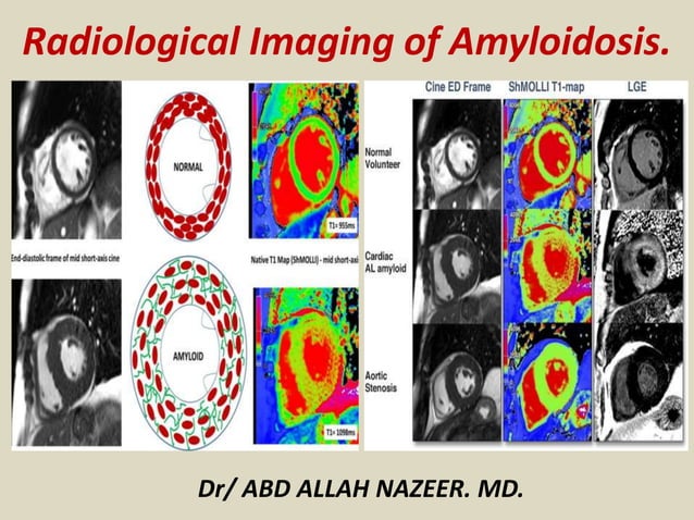 Presentation1, radiological imaging of amyloidosis. | PPTX