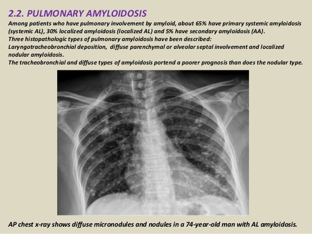Presentation1, radiological imaging of amyloidosis.