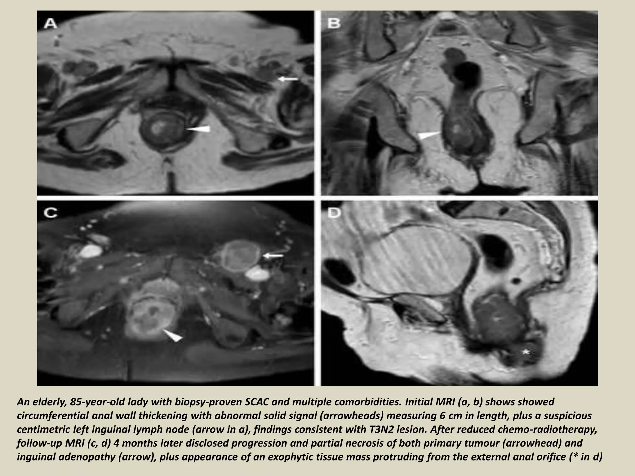 Presentation1, radiological imaging of anal carcinoma. | PPTX