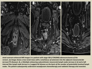 Presentation1, radiological imaging of anal carcinoma. | PPTX