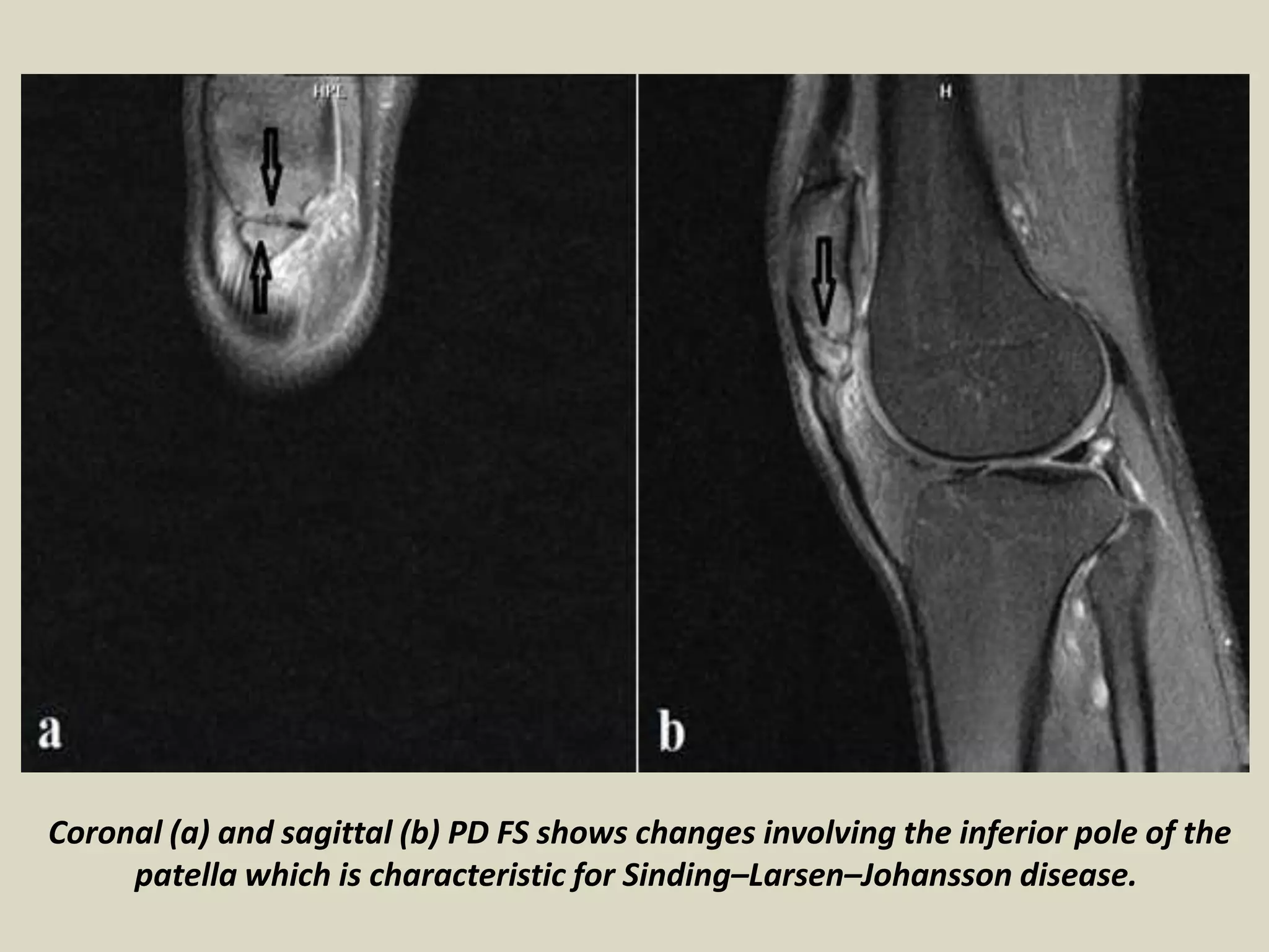 Presentation1, radiological imaging of anterior knee pain. | PPTX
